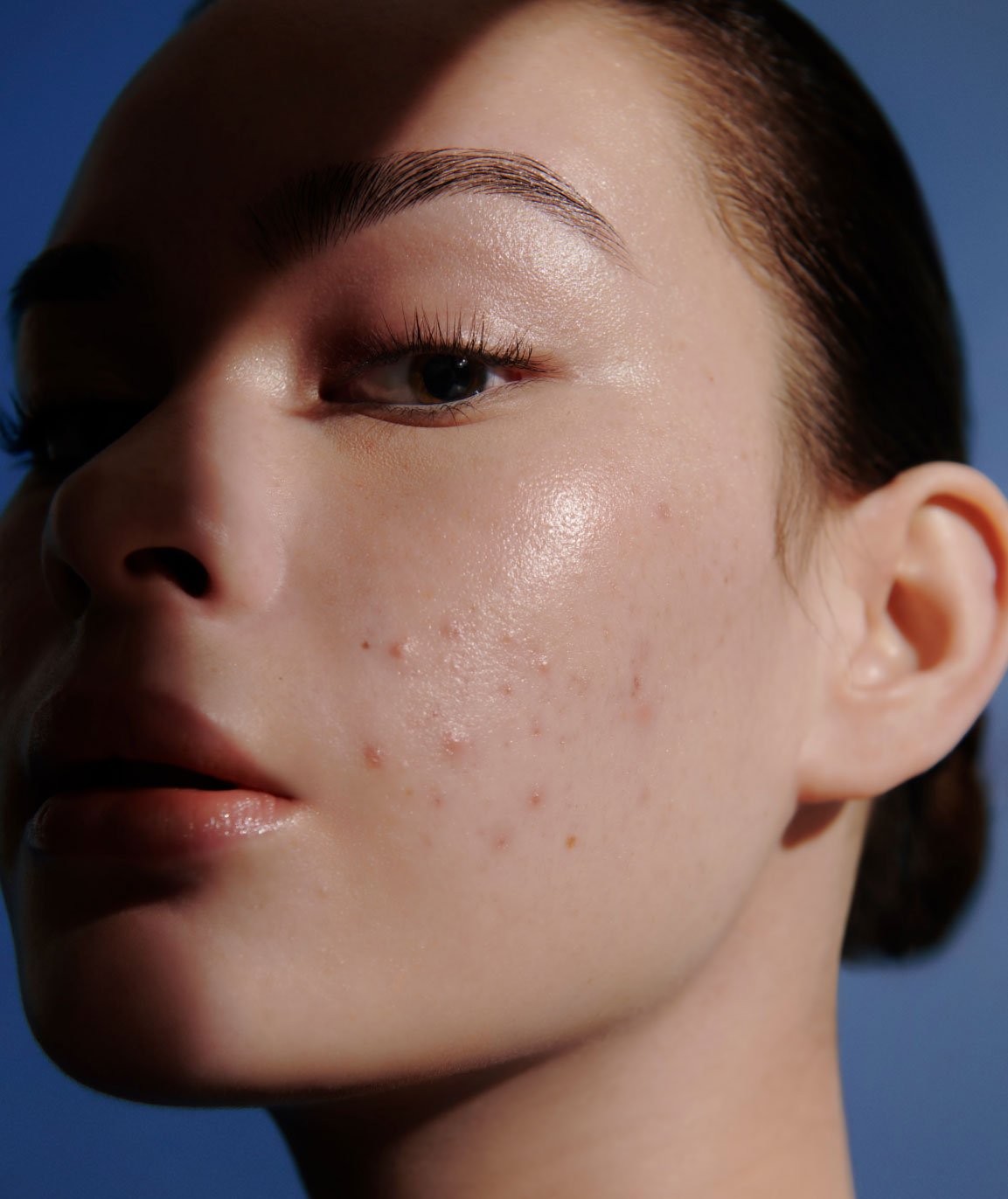 Retin A Ortho Dermatologics